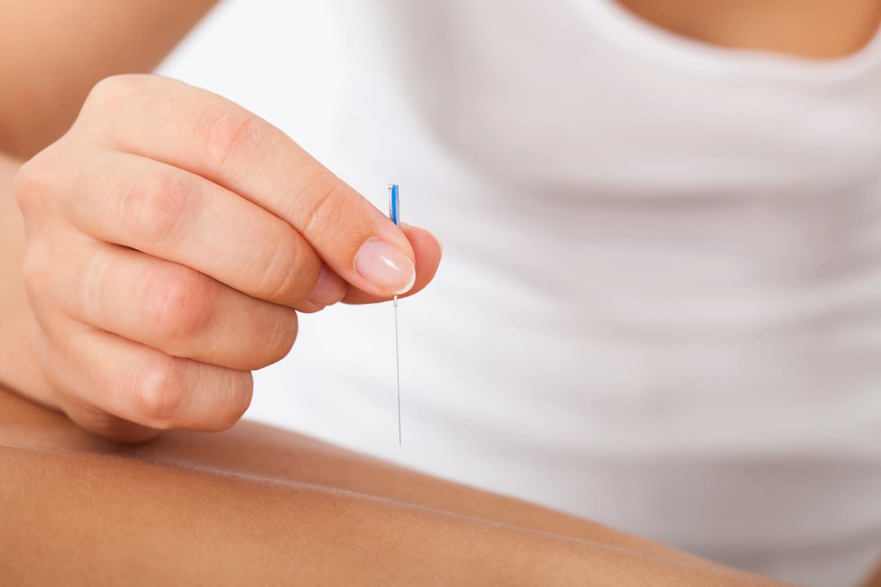 Physiotherapy vs. Acupuncture: Helping You Make the Right Choice ...